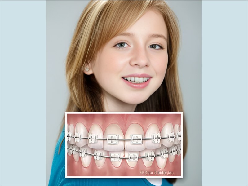 Types of Braces | Noble Orthodontics Solutions