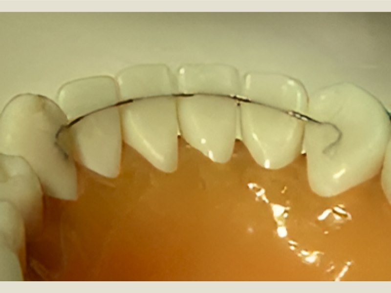 Retention | Noble McClintock Orthodontics | San Angelo TX